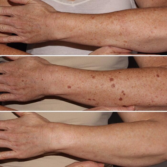 Dermal Fillers Aftercare - Skin Treatment in Hamilton, NJ